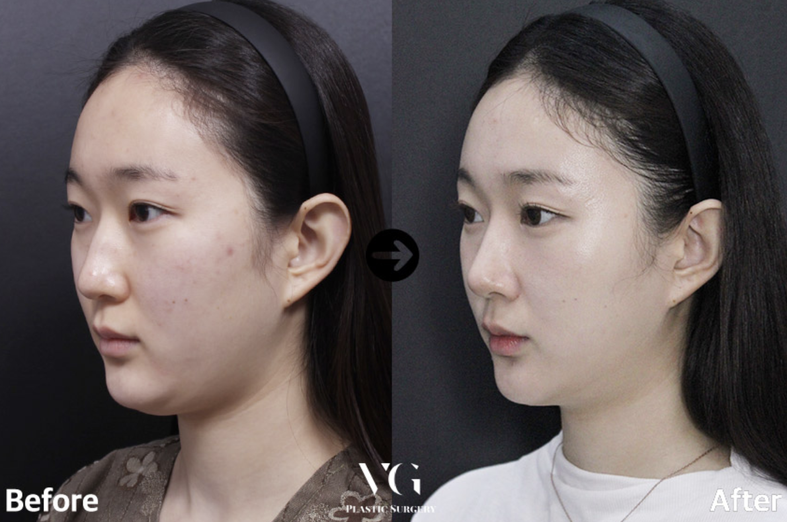 Plastic Surgery Before & After Photos Korea