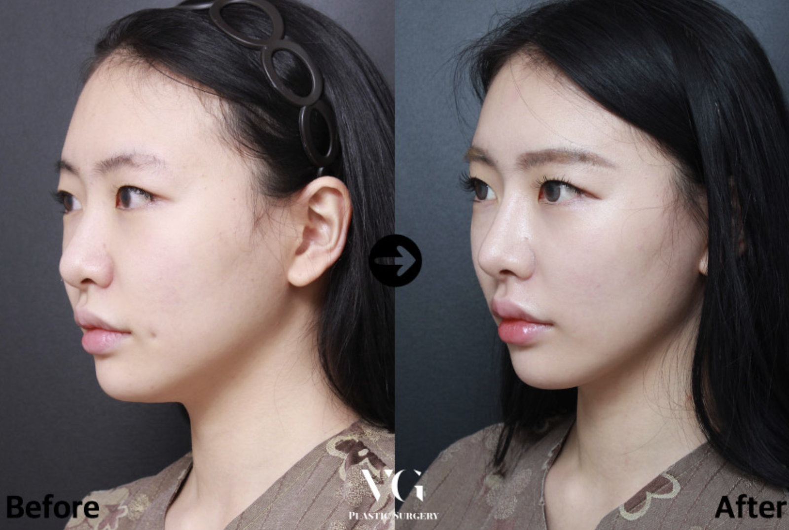 Facelift Seoul | Korea Face Lift Plastic Surgeon